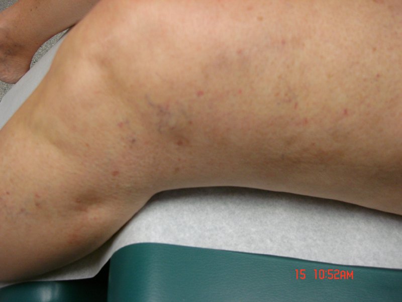 Varicose & Spider Vein Treatments Before & After